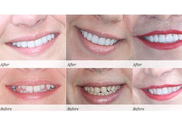 Teeth Treat How Much For Professional Teeth Whitening